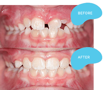 Invisalign® for Kids Treatment in Calgary AB | TruSmile Dental